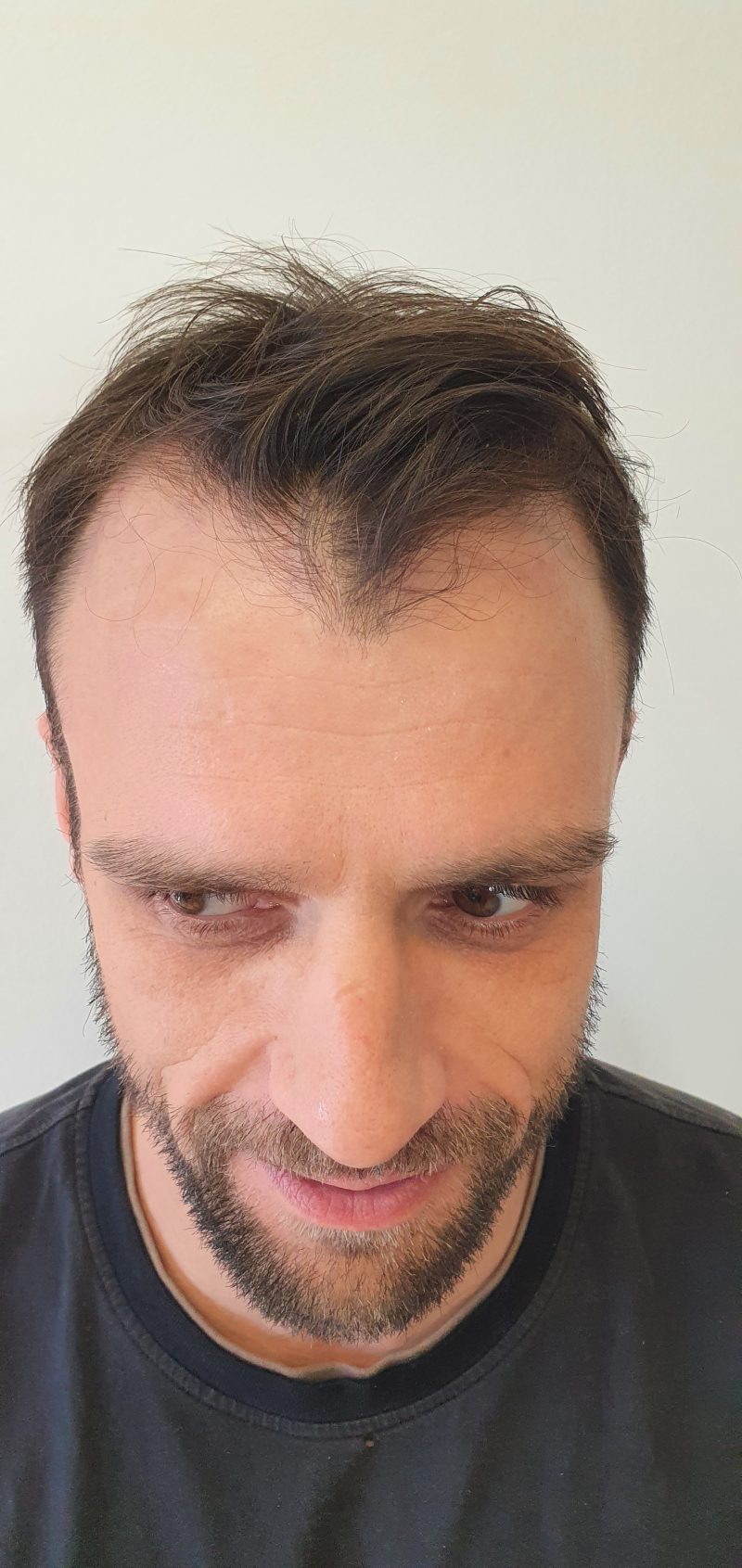 Ciaran Griffiths Talks about Hair Transplants - FUE Hair | Elite Hair ...