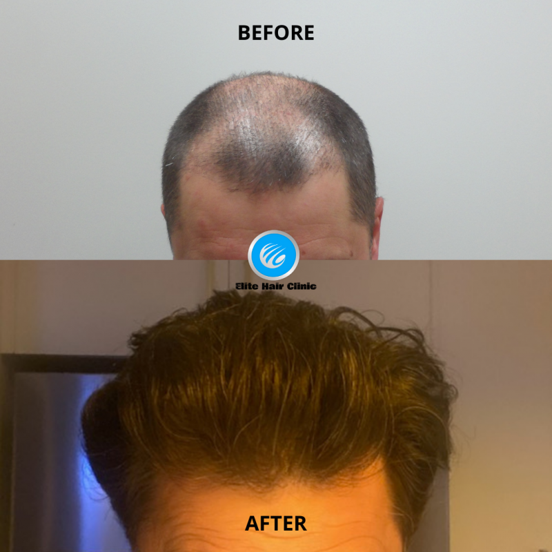 Before and After Hair Transplant in Sydney | Elite Hair Clinic Sydney