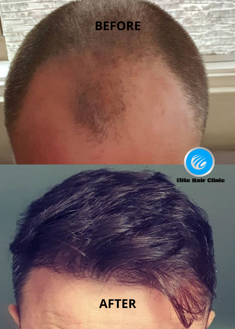 Before and After Hair Transplant in Sydney | Elite Hair Clinic Sydney