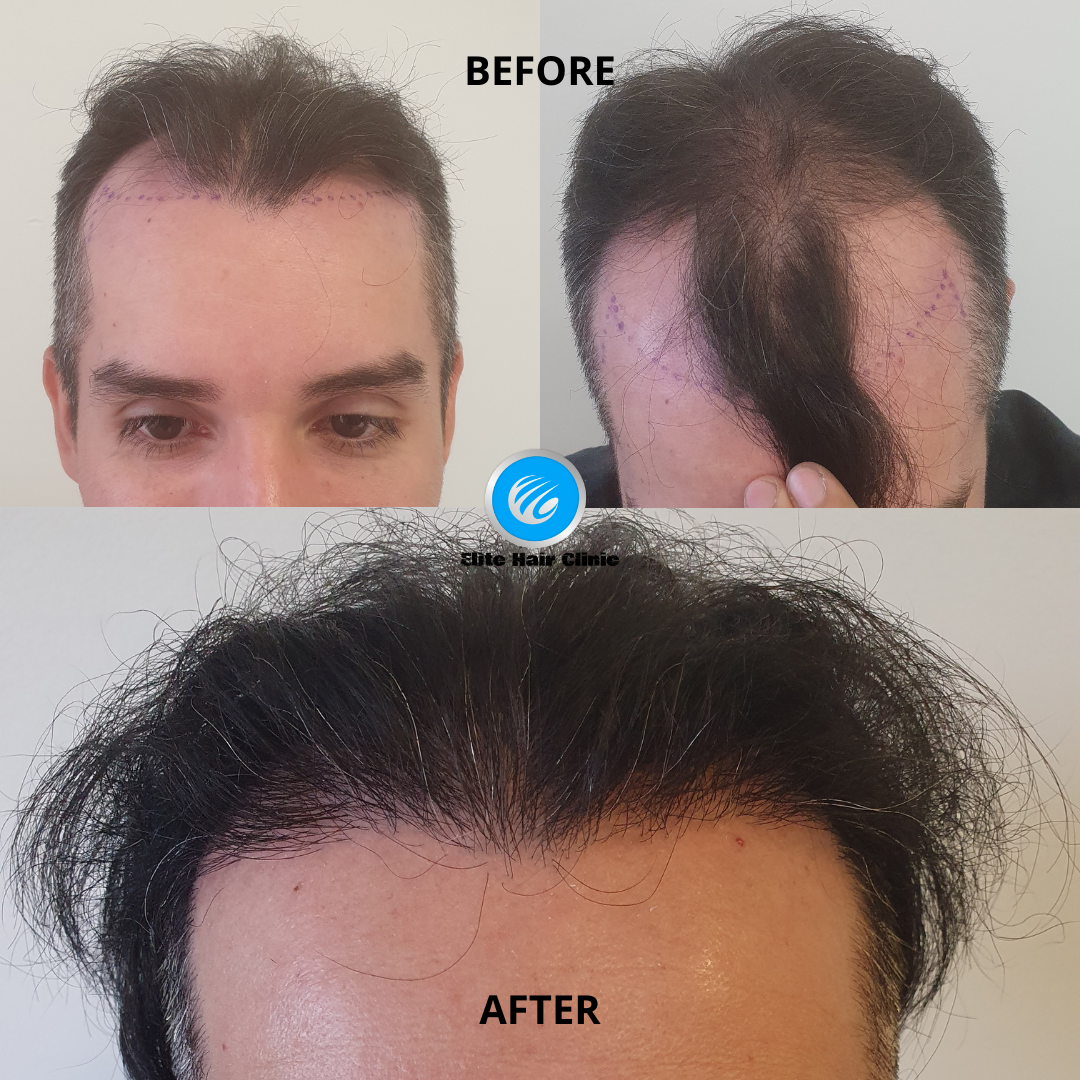 Before and After Hair Transplant in Sydney | Elite Hair Clinic Sydney