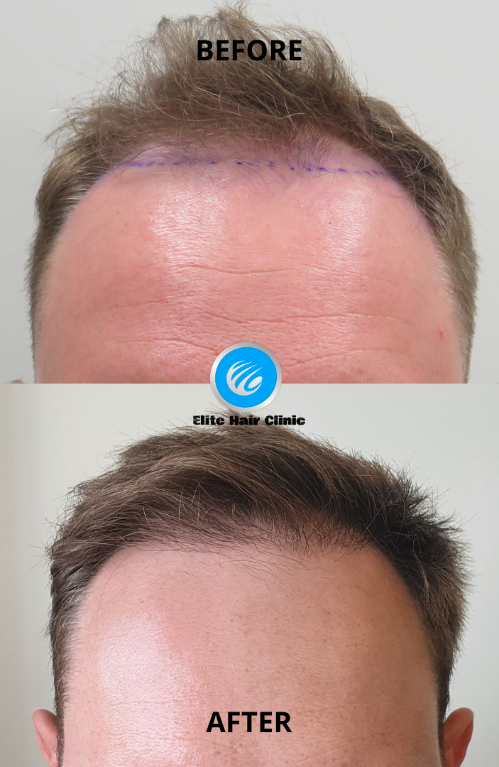Before and After Hair Transplant in Sydney | Elite Hair Clinic Sydney