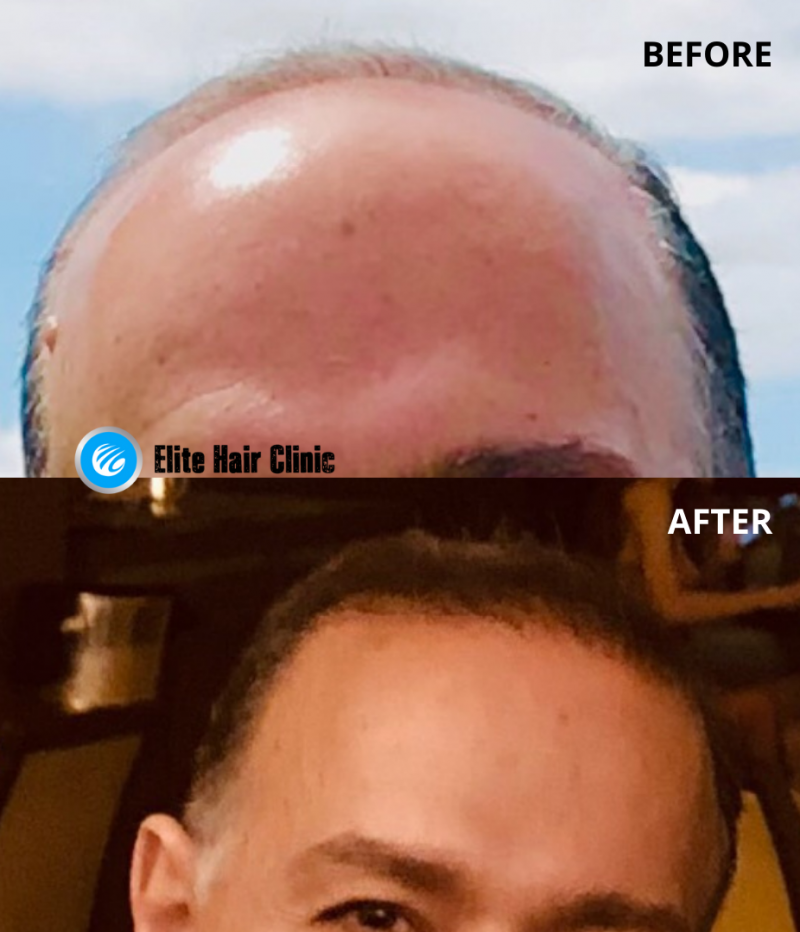 Before and After Hair Transplant in Sydney | Elite Hair Clinic Sydney