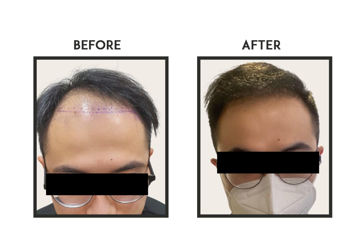 Before and After Hair Transplant in Sydney | Elite Hair Clinic Sydney